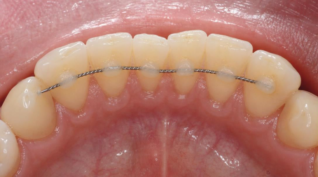 Fixed Retainer UK: Permanent vs Removable Retainer — Which Is Right fo ...